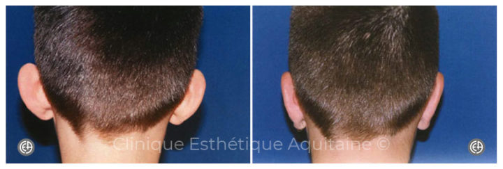 Otoplastie Bordeaux : Chirurgie esthétique des oreilles décollées