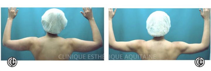 Liposuccion HD des bras - Clinique Esthétique Aquitaine