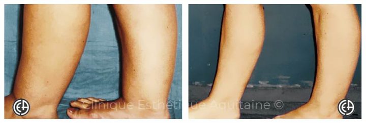 Lipoedème : Tout savoir en 2022