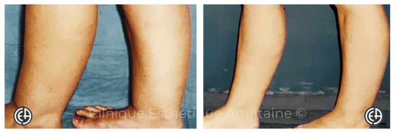 Lipoedeme jambes - Clinique Esthétique Aquitaine